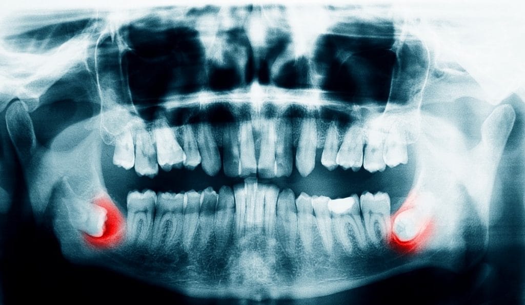 Simple vs Surgical Tooth Extraction Explained